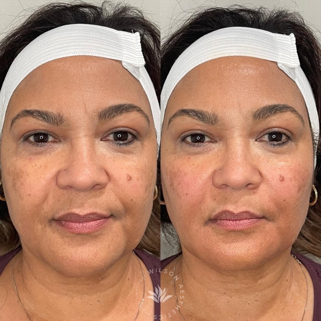 Sculptra Aesthetic | Prescott Valley - Wilson Aesthetics