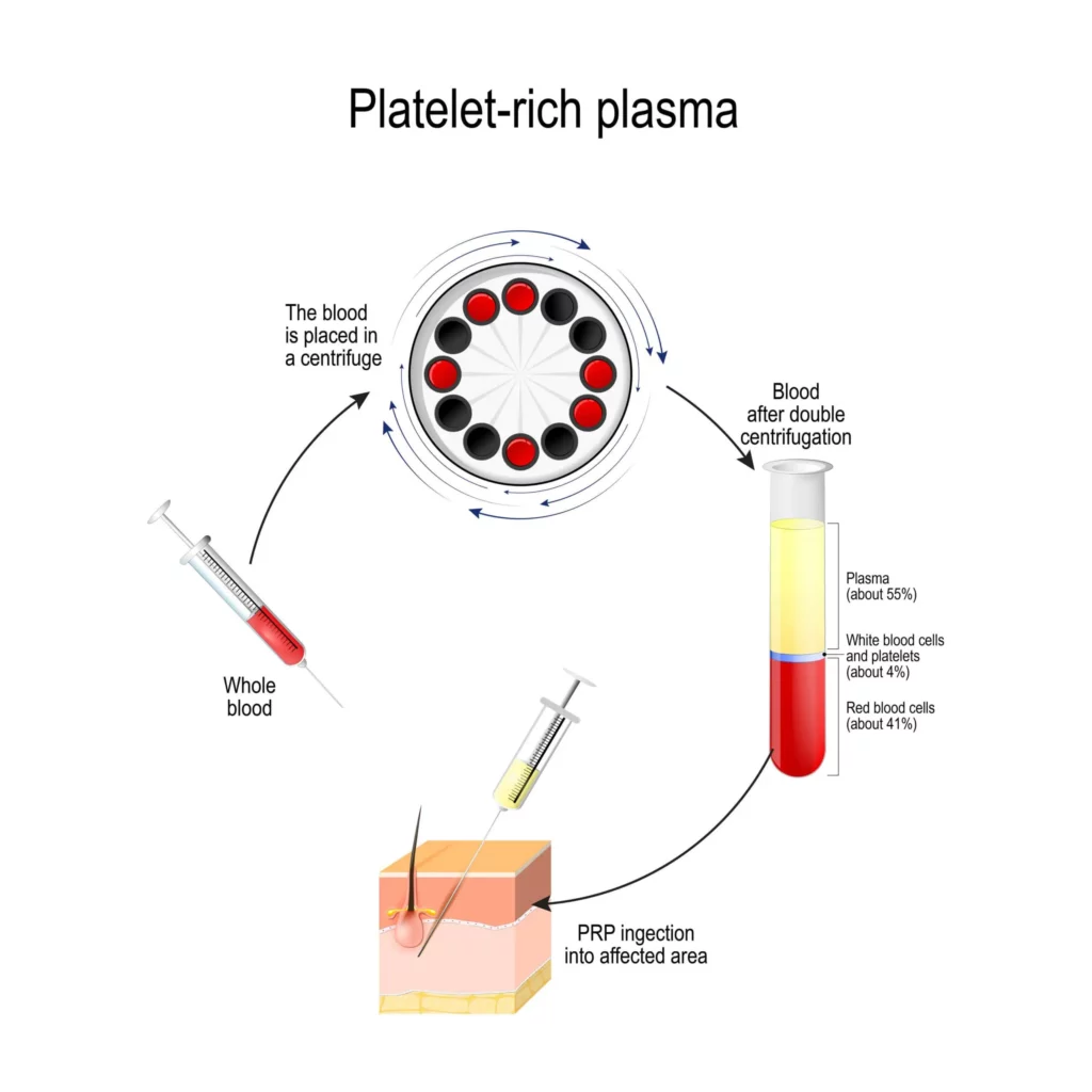 Platelet rich Plasma: Is it effective for facial renew?